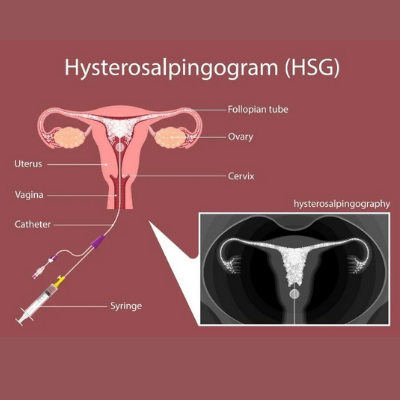 What is HSG | Procedure of HSG test | Chandigarh-dr. Shikha